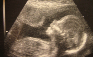 Baby's genome sequenced before birth | Science Illustrated